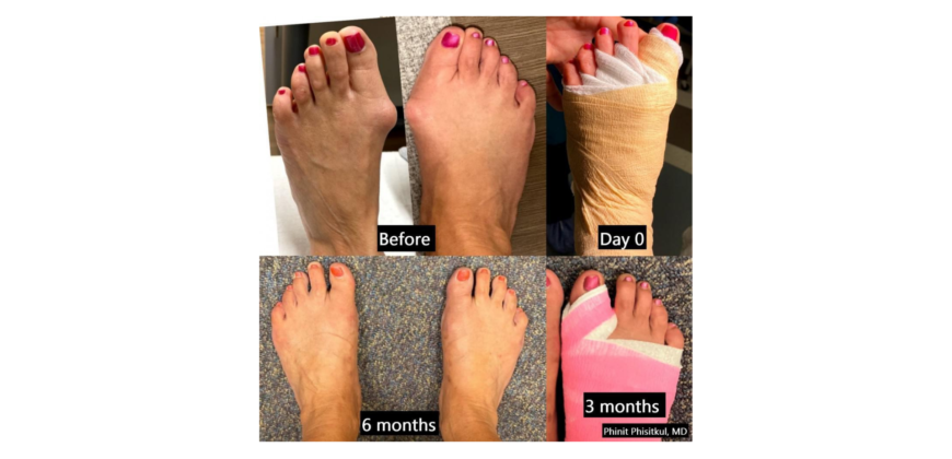 Minimally Invasive Bunion Correction | CNOS, PC