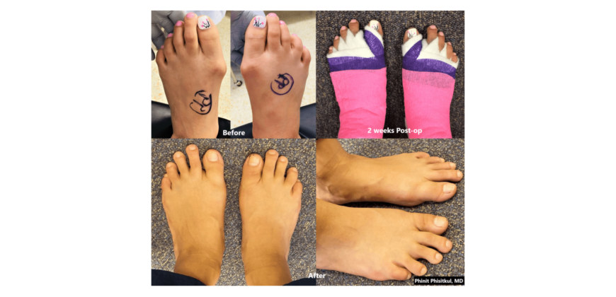 Minimally Invasive Bunion Correction | CNOS, PC