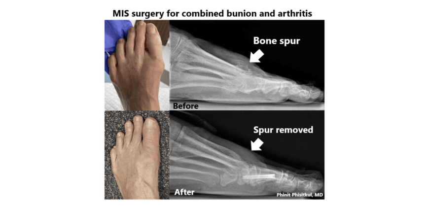 Minimally Invasive Bunion Correction | CNOS, PC