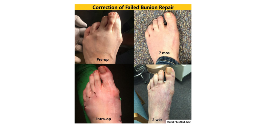 Minimally Invasive Bunion Correction | CNOS, PC