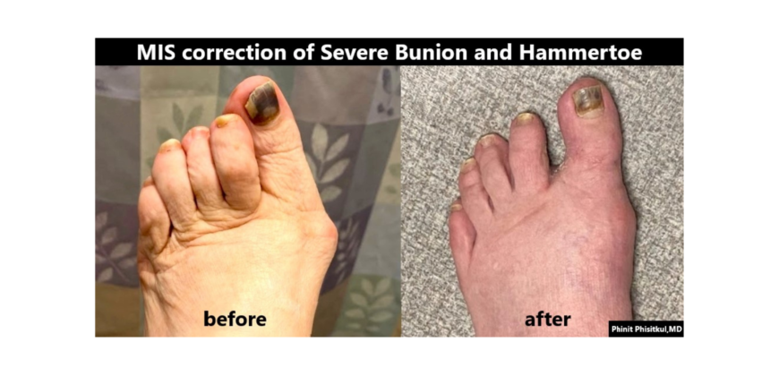 Minimally Invasive Bunion Correction | CNOS, PC