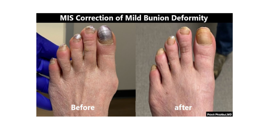 Minimally Invasive Bunion Correction | CNOS, PC