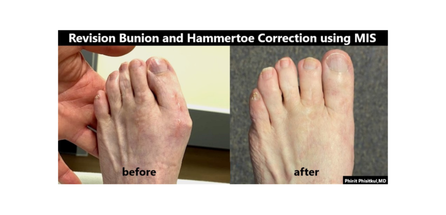 Minimally Invasive Bunion Correction | CNOS, PC