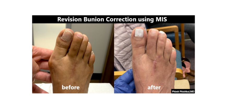 Minimally Invasive Bunion Correction | CNOS, PC