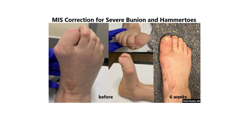 Minimally Invasive Bunion Correction | CNOS, PC