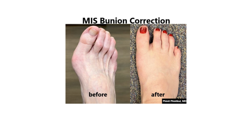 Minimally Invasive Bunion Correction | CNOS, PC