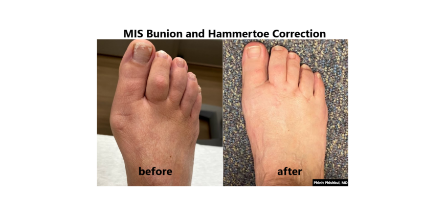 Minimally Invasive Bunion Correction | CNOS, PC