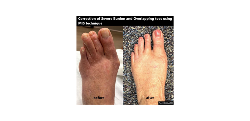 Minimally Invasive Bunion Correction | CNOS, PC