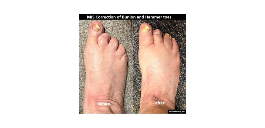 Minimally Invasive Bunion Correction | CNOS, PC