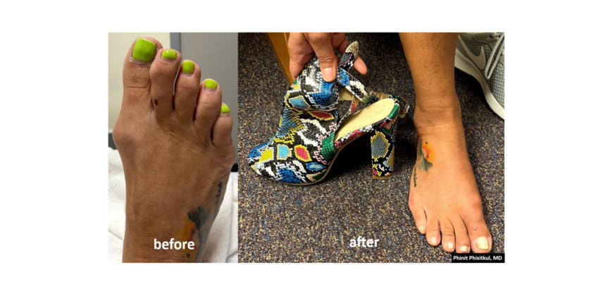 Minimally Invasive Bunion Correction | CNOS, PC