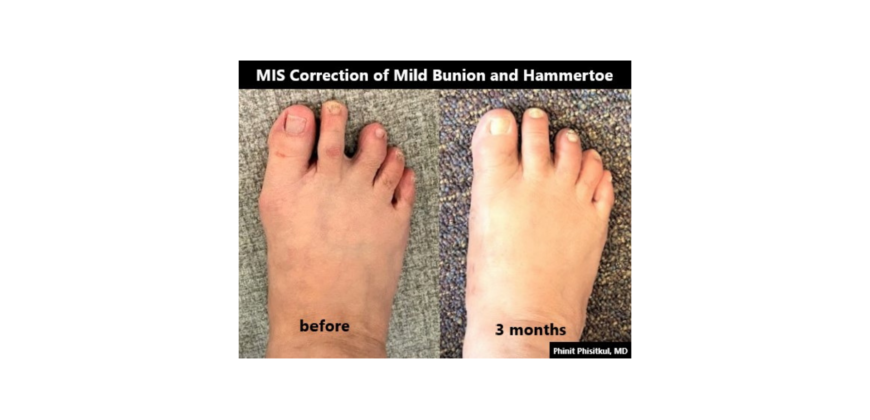 Minimally Invasive Bunion Correction | CNOS, PC