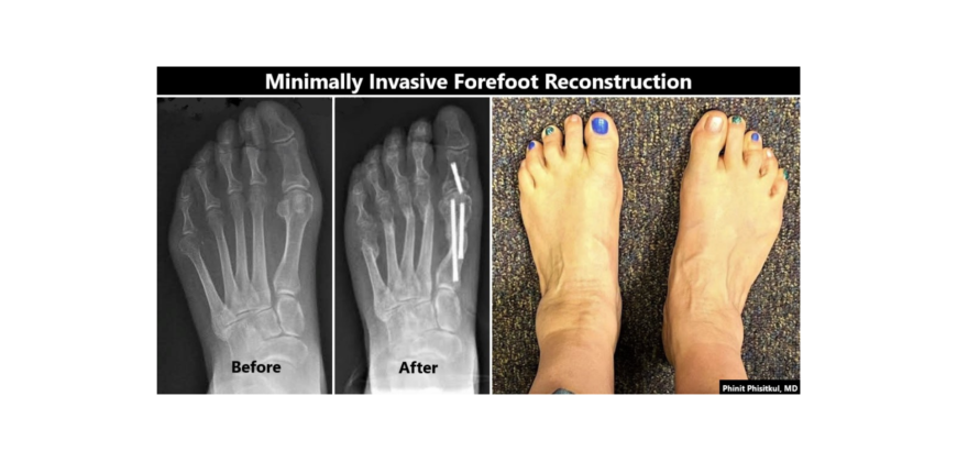 Minimally Invasive Bunion Correction | CNOS, PC