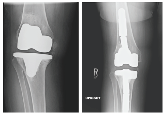 Painful Total Knee Arthroplasty Diagnosis | CNOS, PC